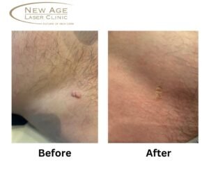Skin tags are harmless, non-cancerous, fleshy, skin growths that are ...